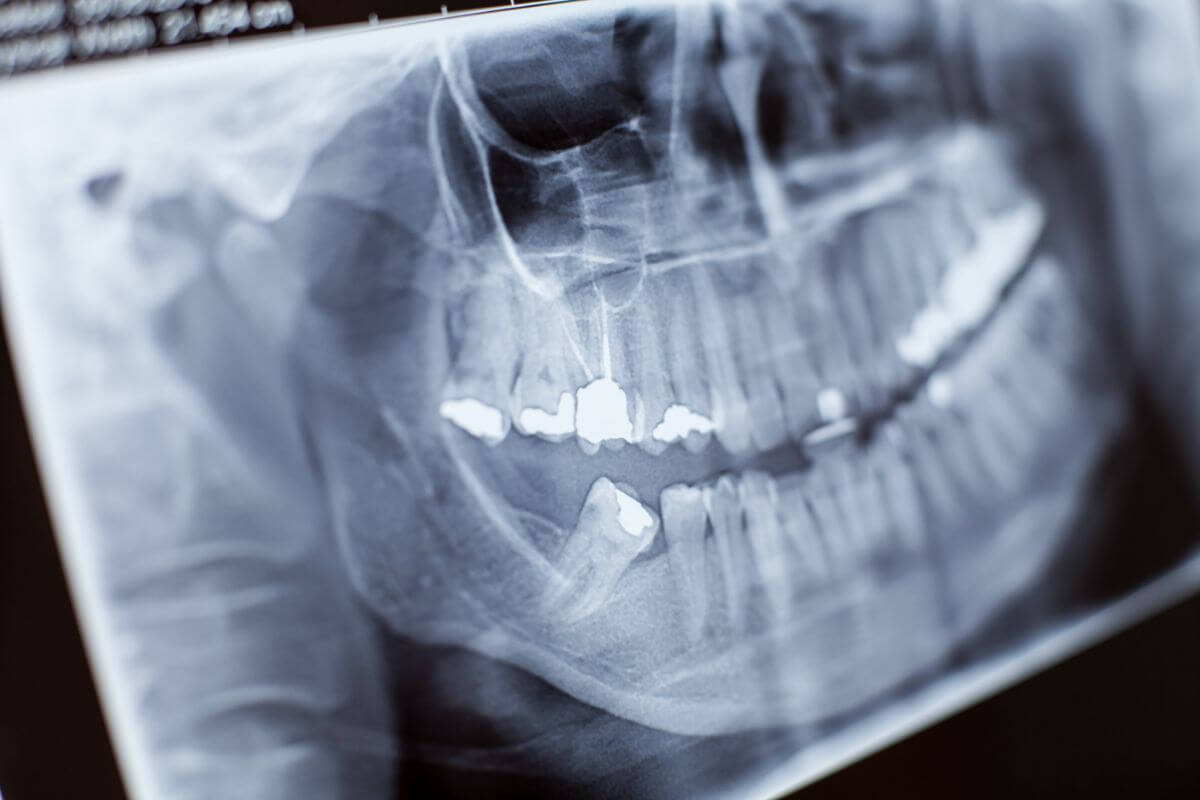 Symptoms of Impacted Teeth