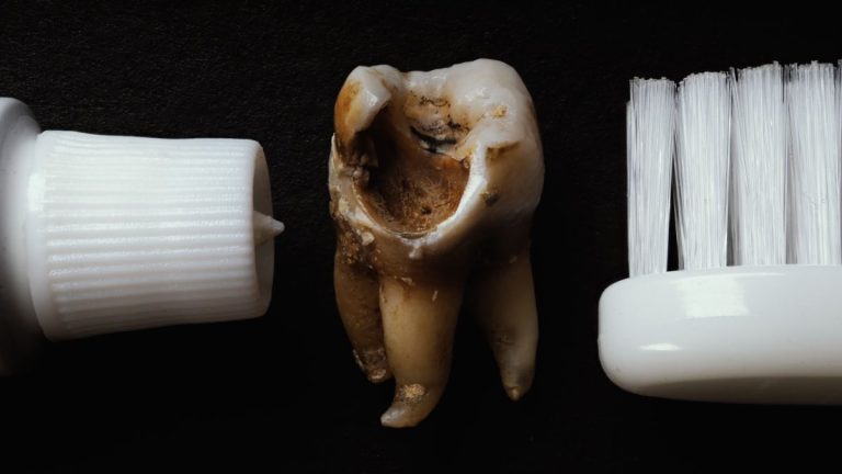 5 Symptoms of Cavities in Teeth